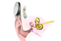 Wie funktioniert ein Cochlea Implantat? - Leben mit hoerverlust.at